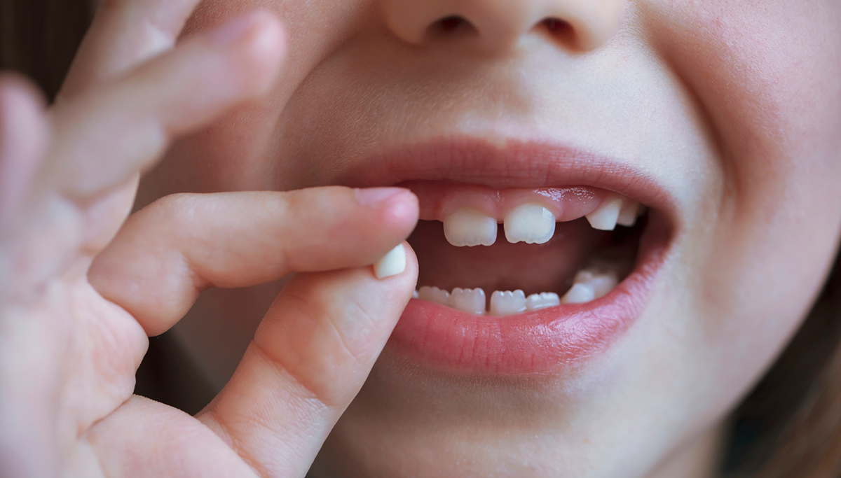 Navigating Tooth Loss During School